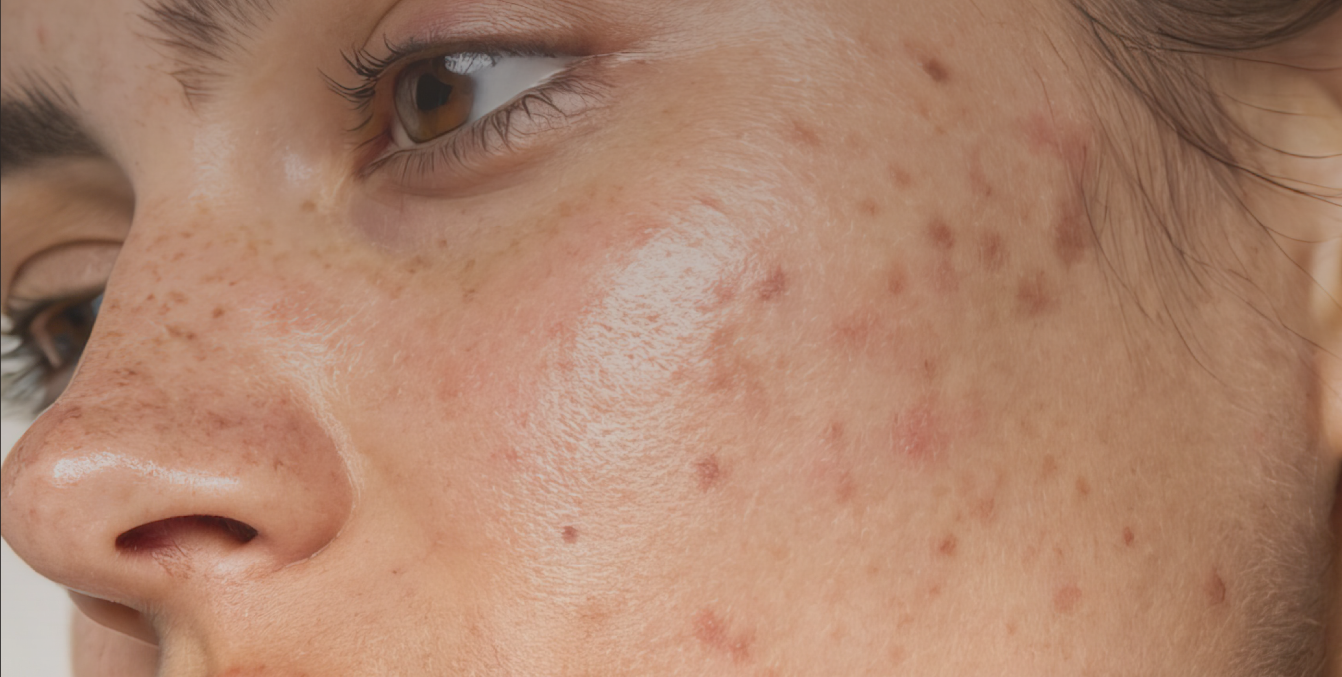 Acne Awareness Month – Iyvos